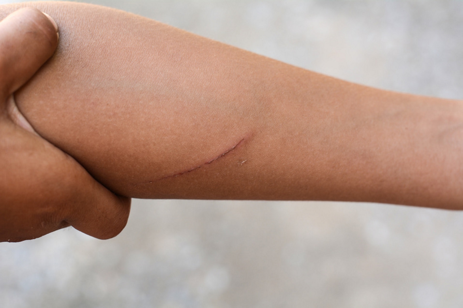 Laceration Injury Claims - How Much Compensation Can I Claim ...