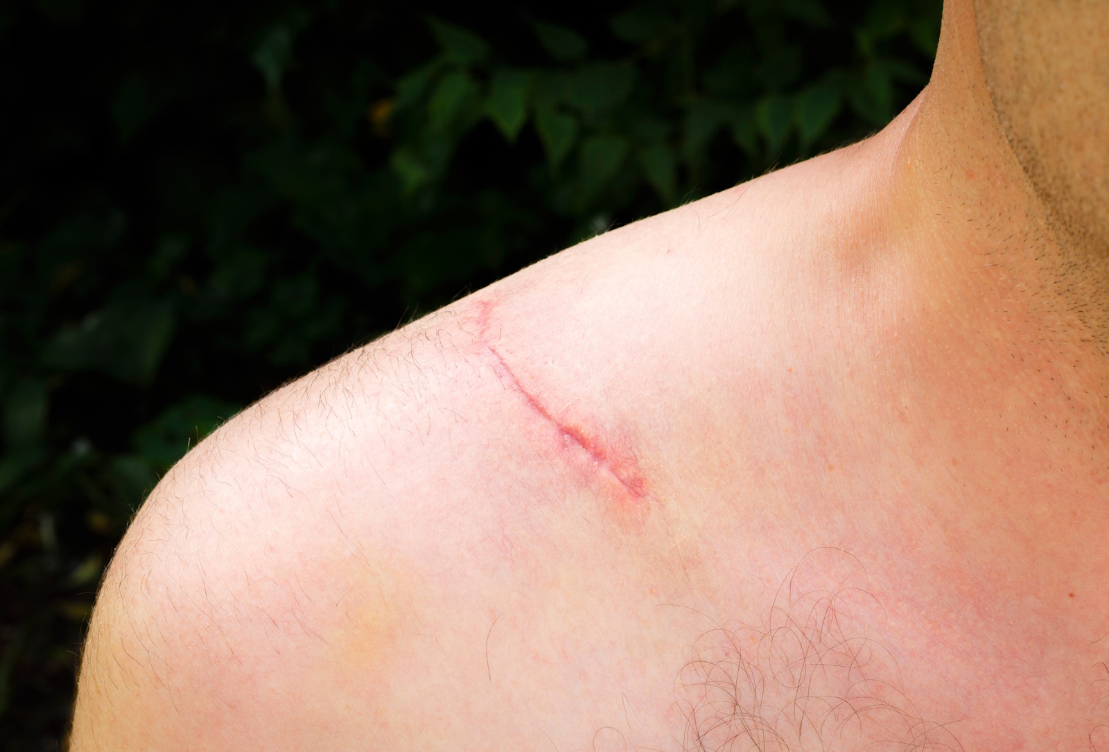 Scar Injury Claims - How Much Compensation Can I Claim? | ClaimsAction ...
